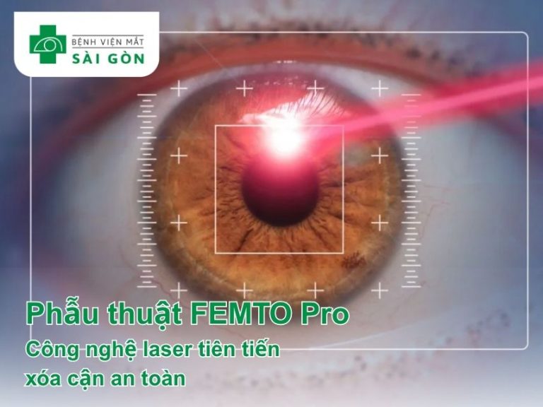 Phẫu thuật FEMTO Pro: Công nghệ xóa cận bằng tia laser