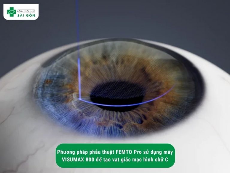 Phẫu thuật FEMTO Pro: Công nghệ xóa cận bằng tia laser